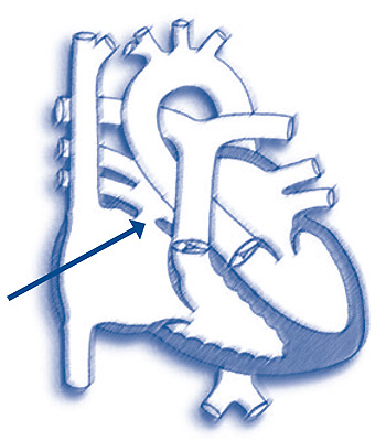 CHAPPS - Atrial Septal Defect (ASD)